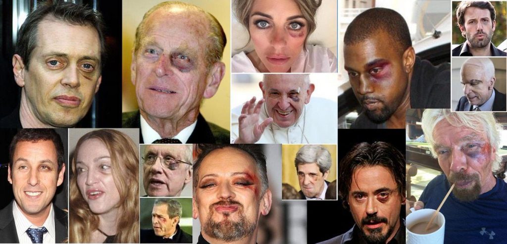 Just What Exactly Is 'The Black Eye Club,' And Why Are So Many ...