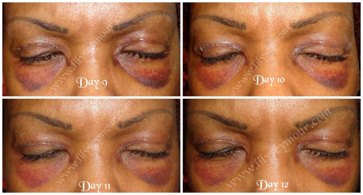 Just What Exactly Is 'The Black Eye Club,' And Why Are So Many ...